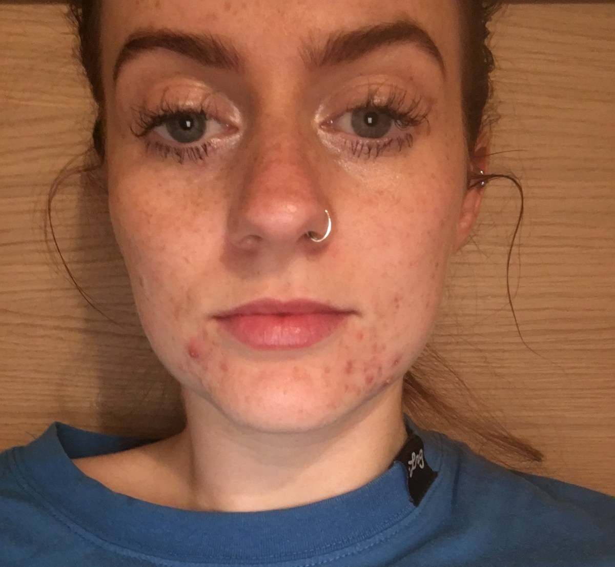 Living with (and treating) adult acne – rachelmollystone.co.uk